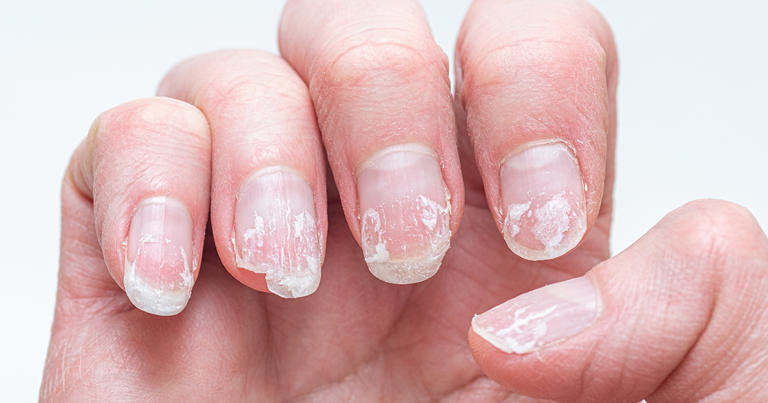 Rippled fingernails reveal secrets of possible disease - Avokaddo.com